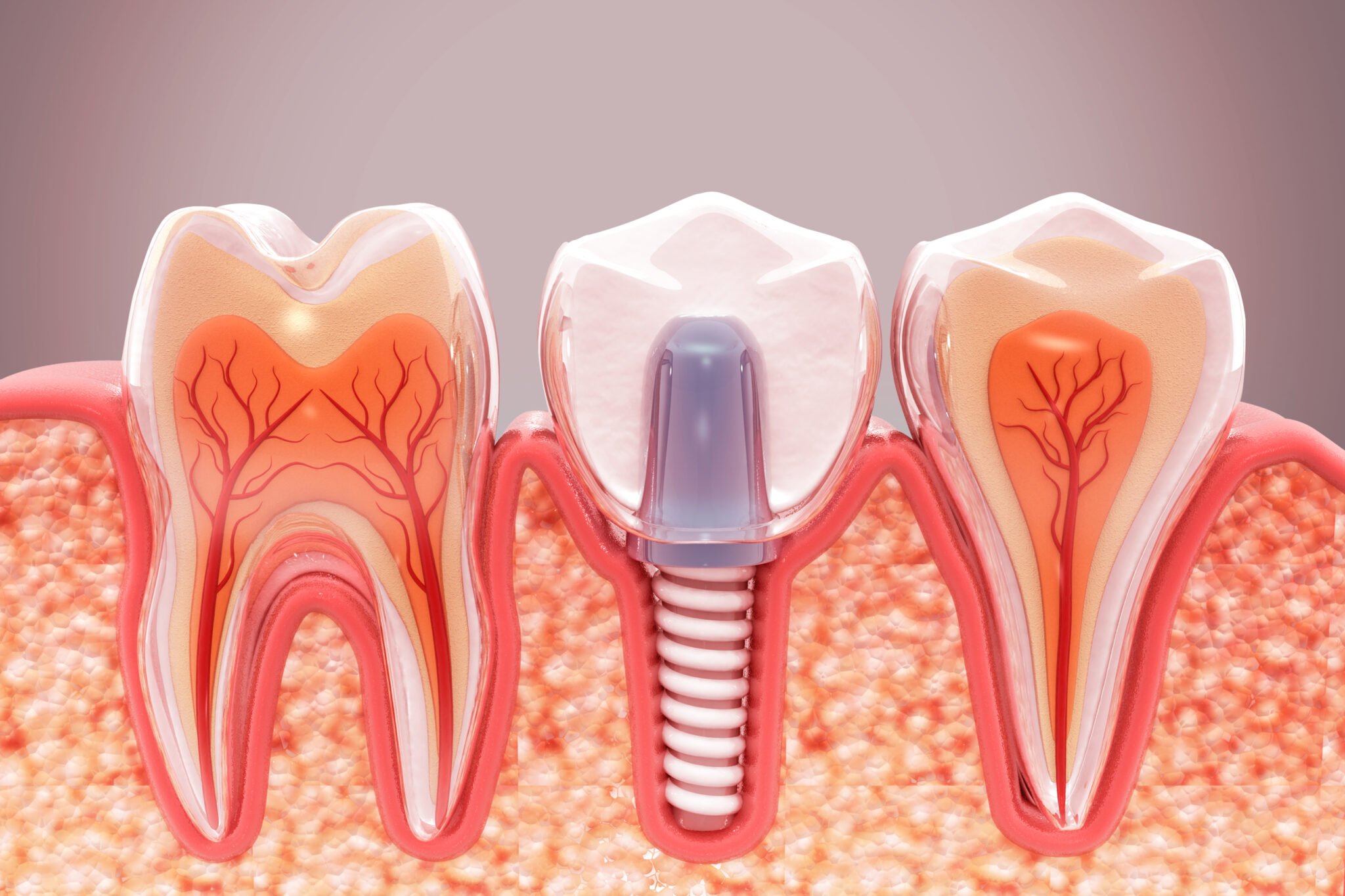 Dental restoration with Inlay, Onlay and Overlay – what are they, what ...