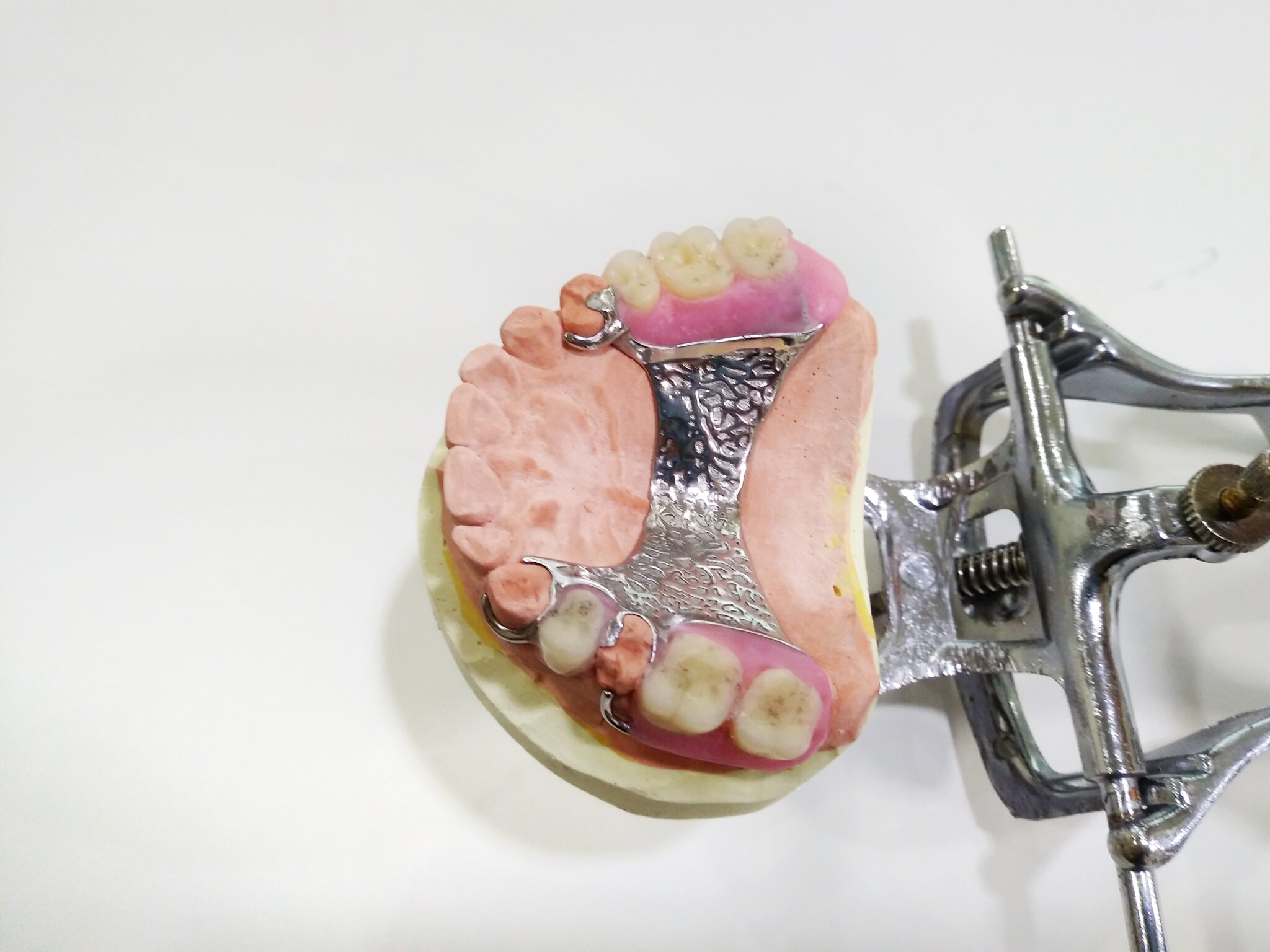 Dental restoration with Inlay, Onlay and Overlay – what are they, what ...