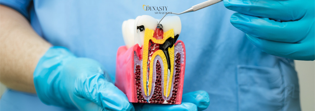 Dental restoration with Inlay, Onlay and Overlay – what are they, what ...